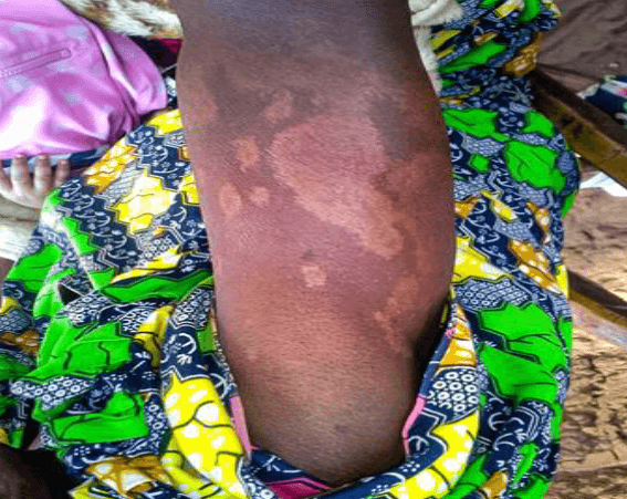 Survey - Provision of healthcare services for neglected tropical ...